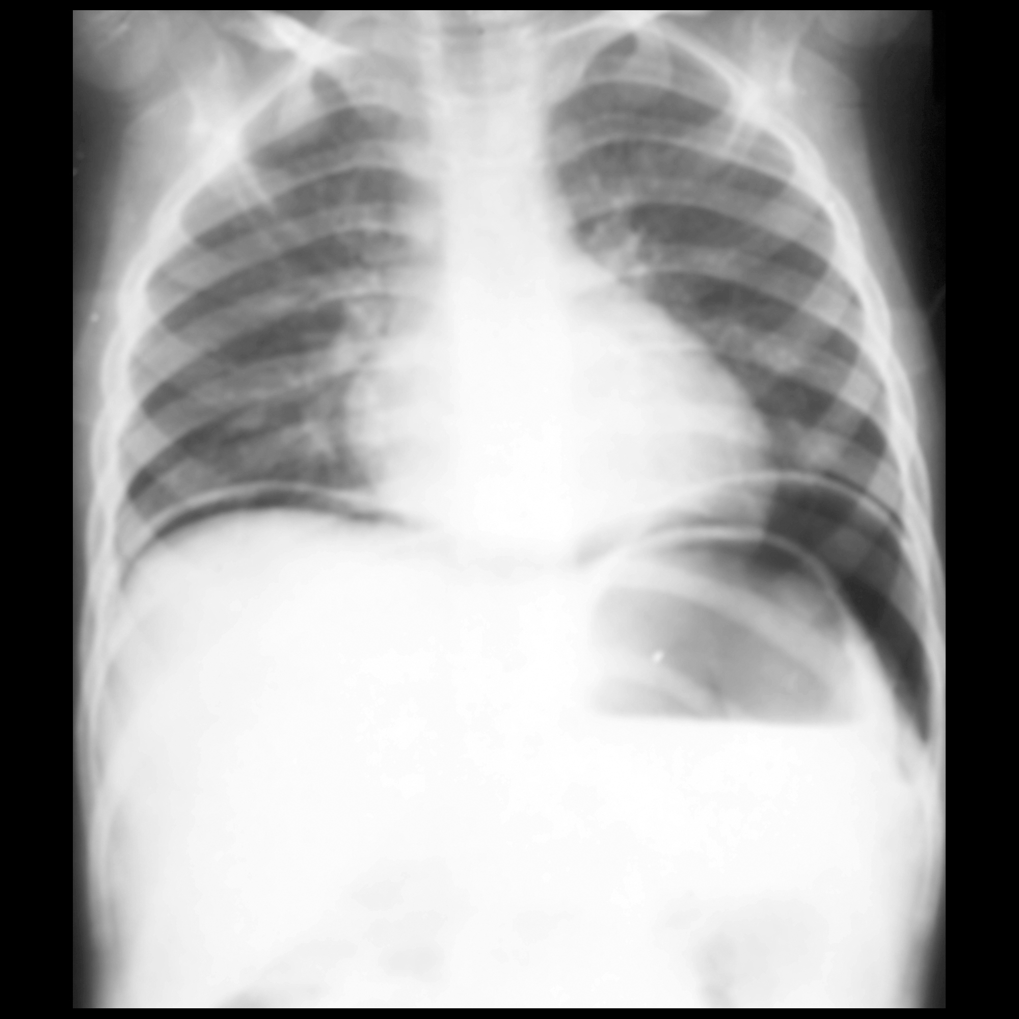 Pediatric Pneumoperitoneum | Pediatric Radiology Reference Article ...