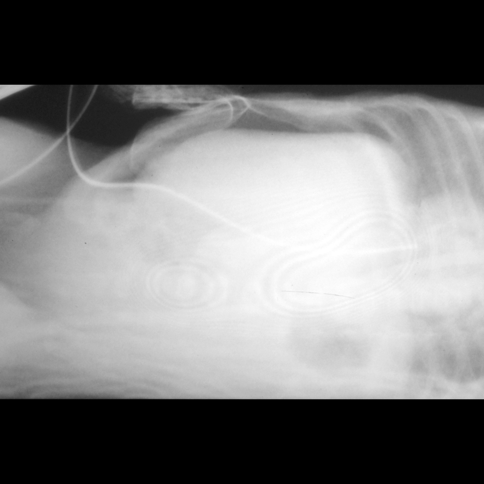 Pediatric Pneumoperitoneum | Pediatric Radiology Reference Article ...