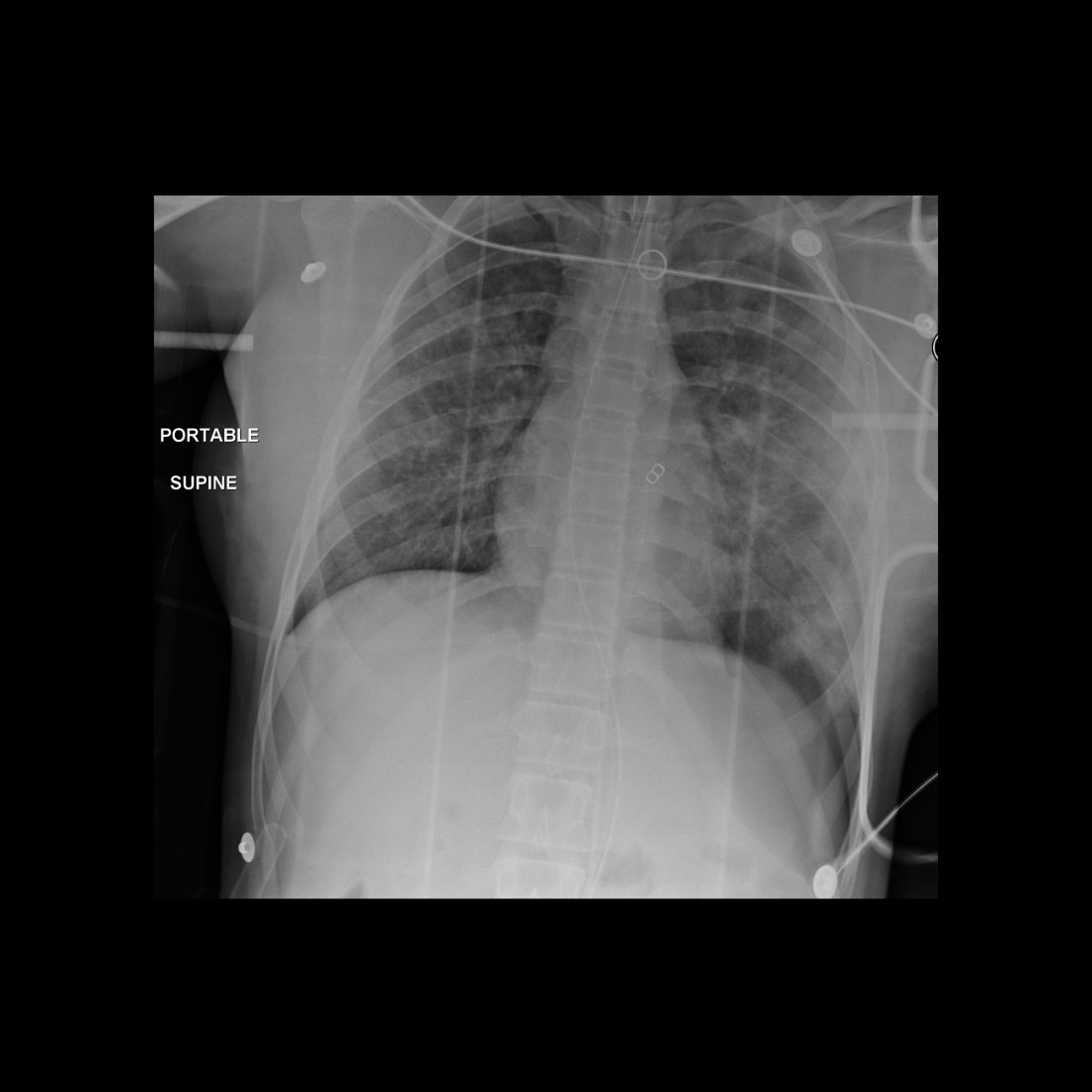Pediatric Pneumothorax | Pediatric Radiology Reference Article ...