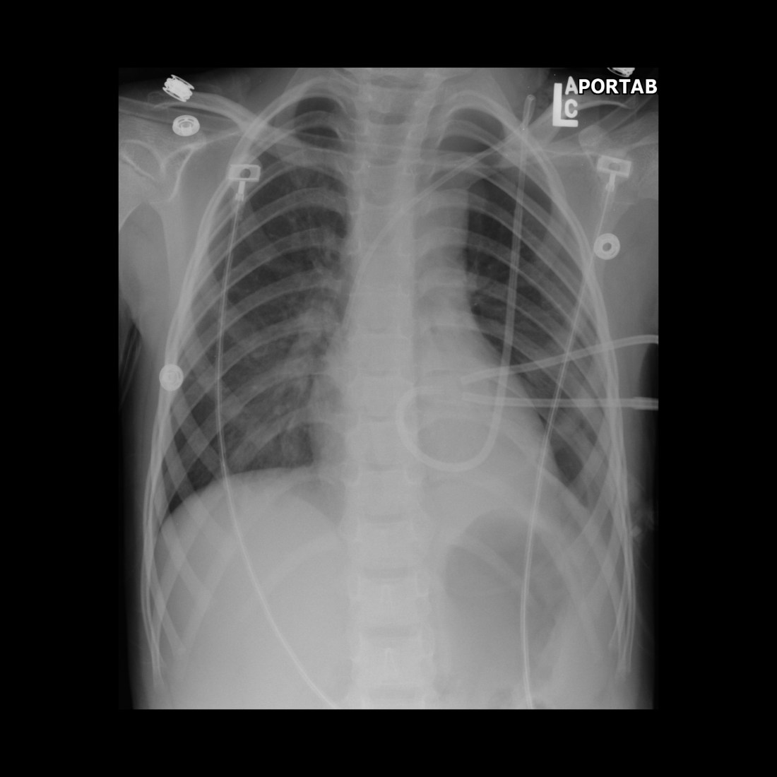 Pediatric Pneumothorax | Pediatric Radiology Reference Article ...