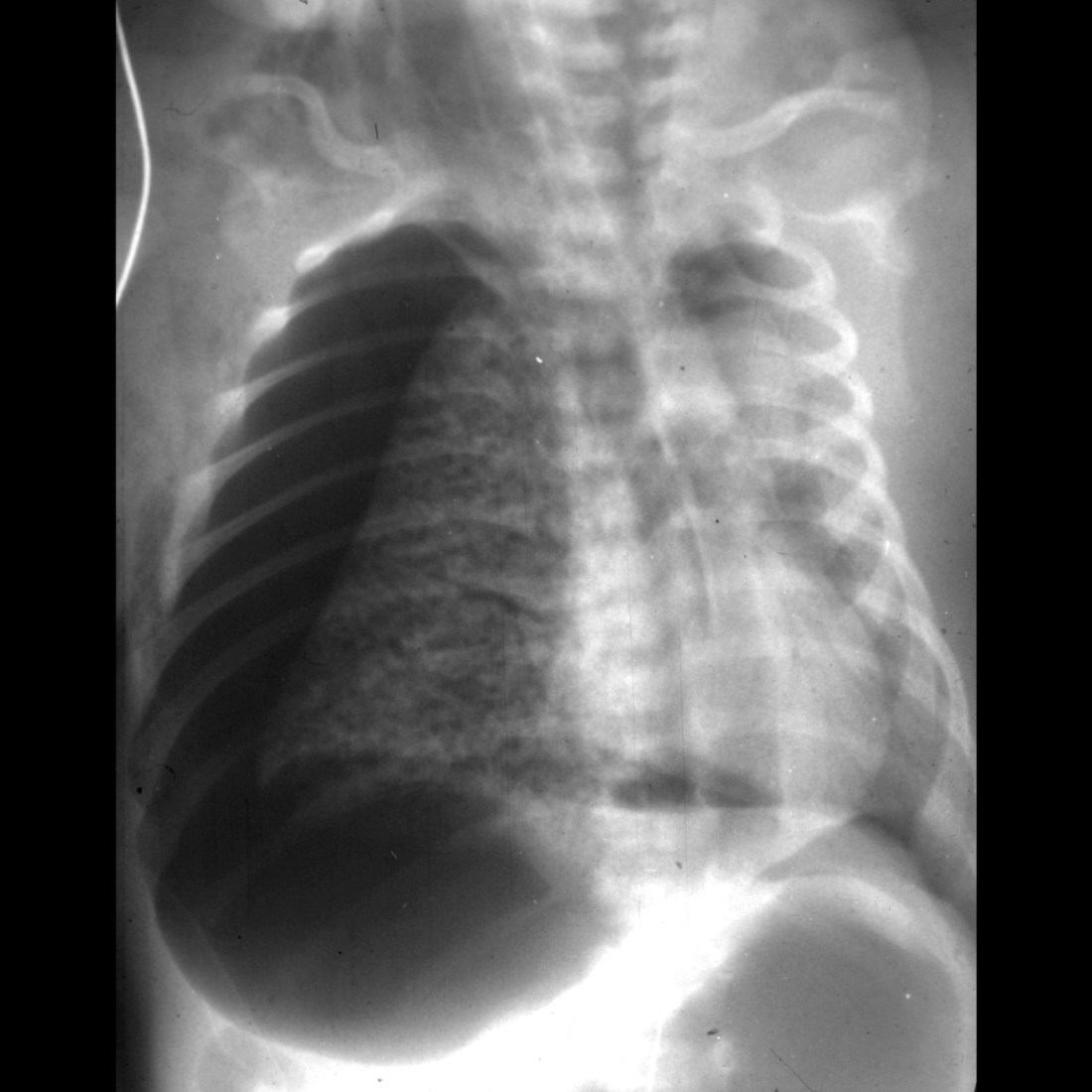 Pediatric Pneumothorax | Pediatric Radiology Reference Article ...