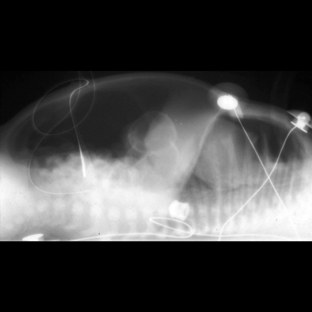 Pediatric Pneumoperitoneum | Pediatric Radiology Reference Article ...