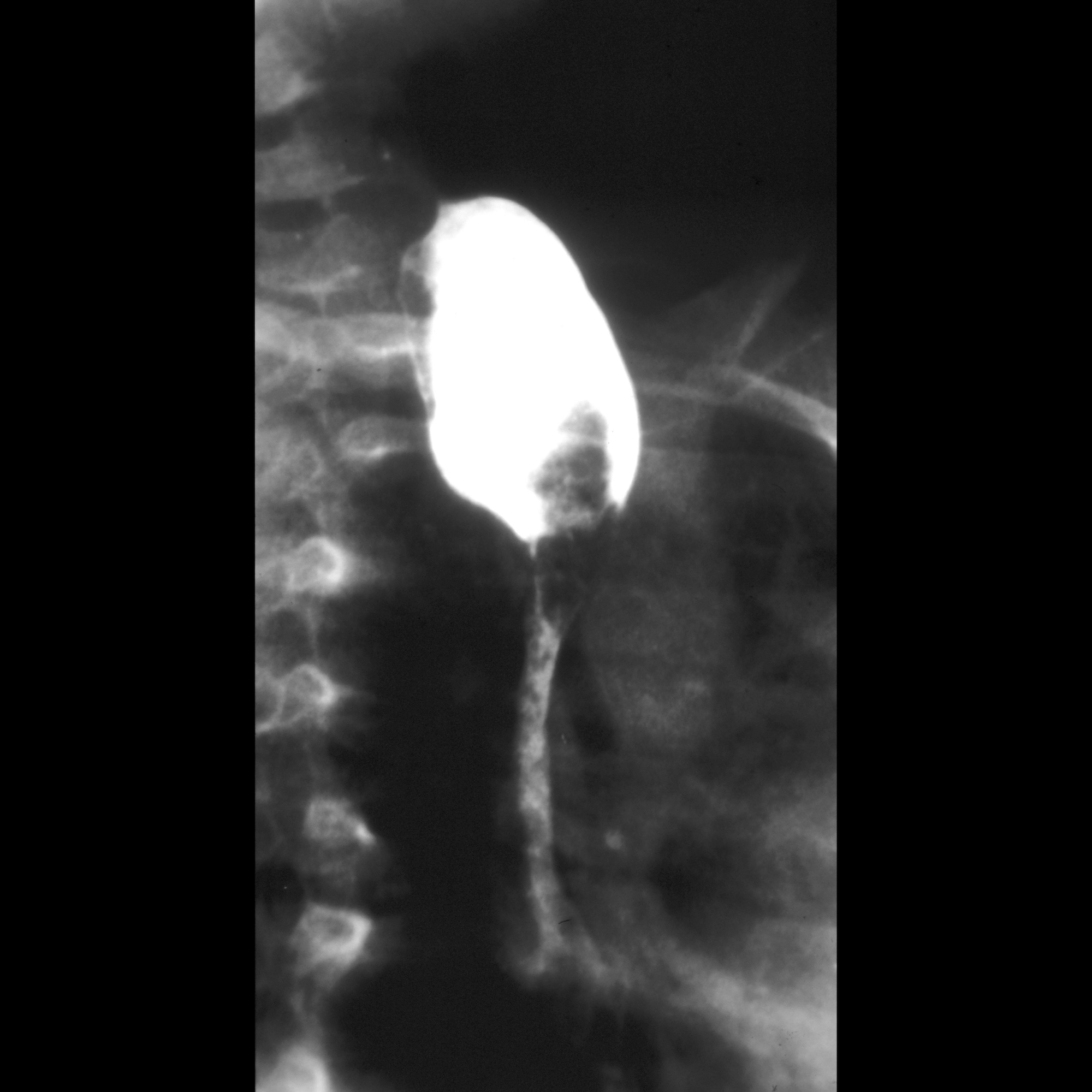 Esophageal Atresia | Pediatric Radiology Reference Article | Pediatric ...