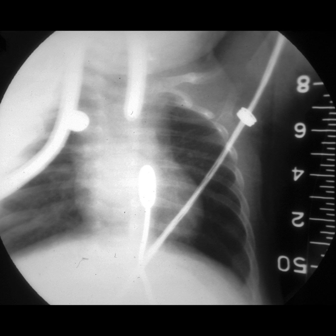 Esophageal Atresia | Pediatric Radiology Reference Article | Pediatric ...