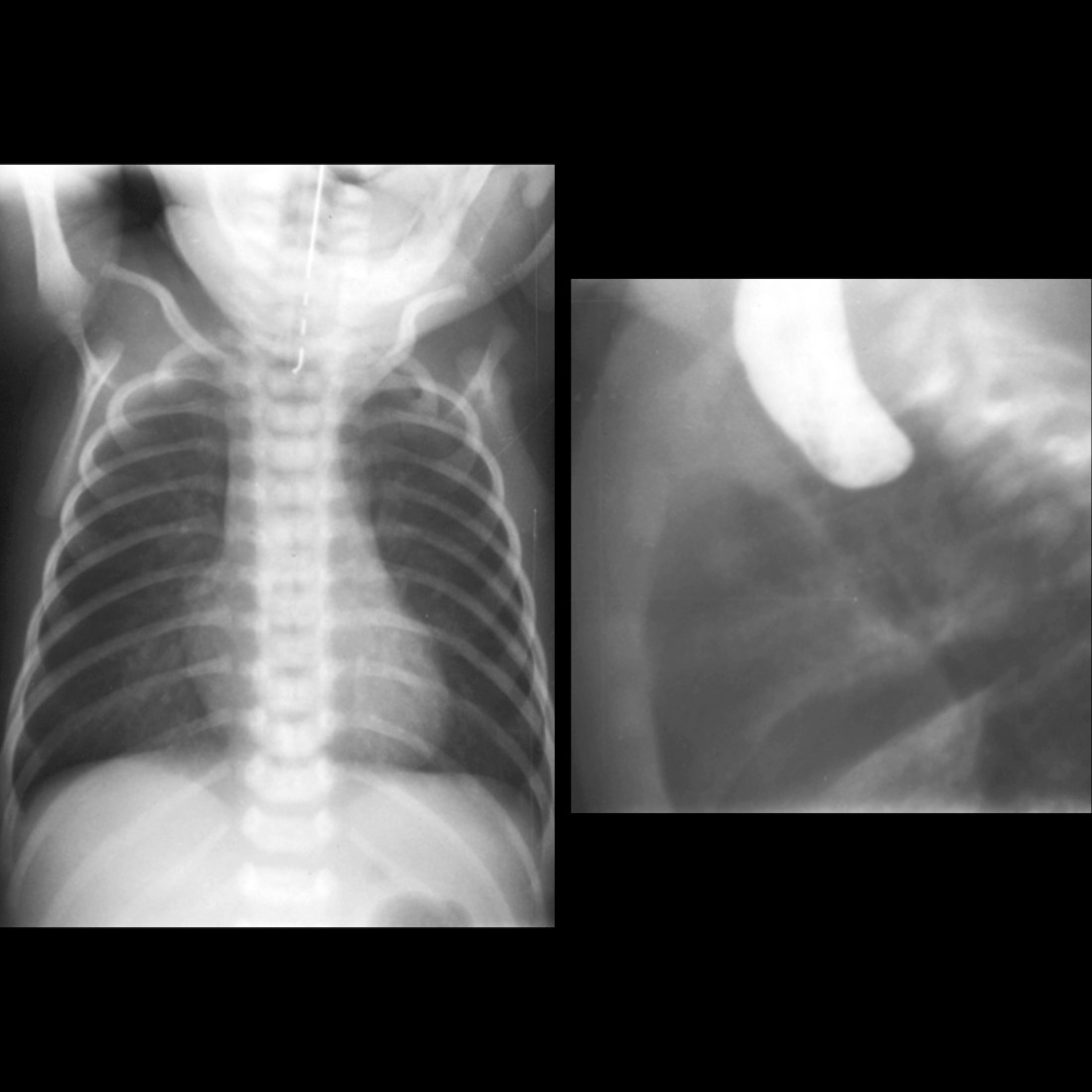Pediatric Tracheobronchomalacia | Pediatric Radiology Reference Article ...