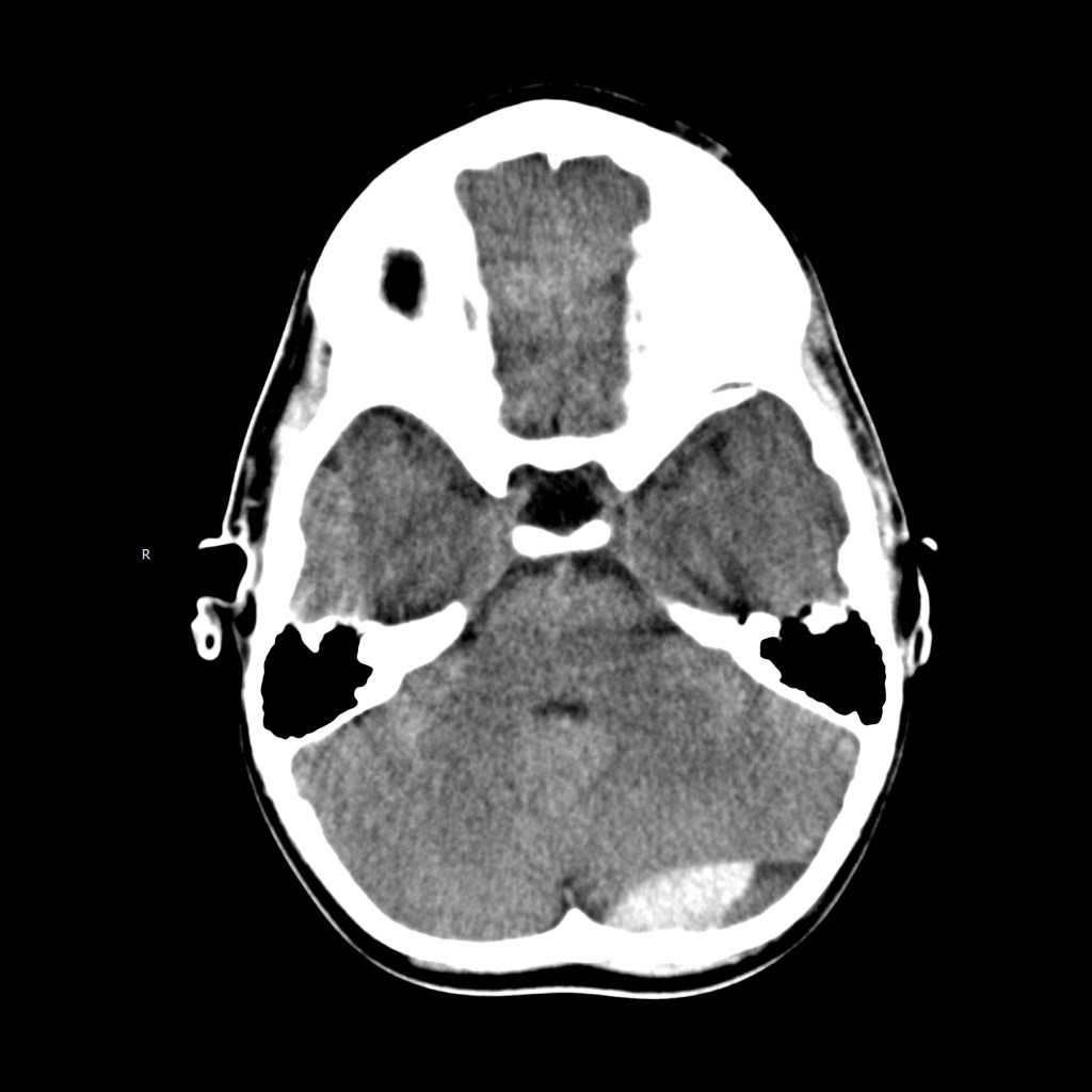 Pediatric Epidural Hematoma | Pediatric Radiology Reference Article ...