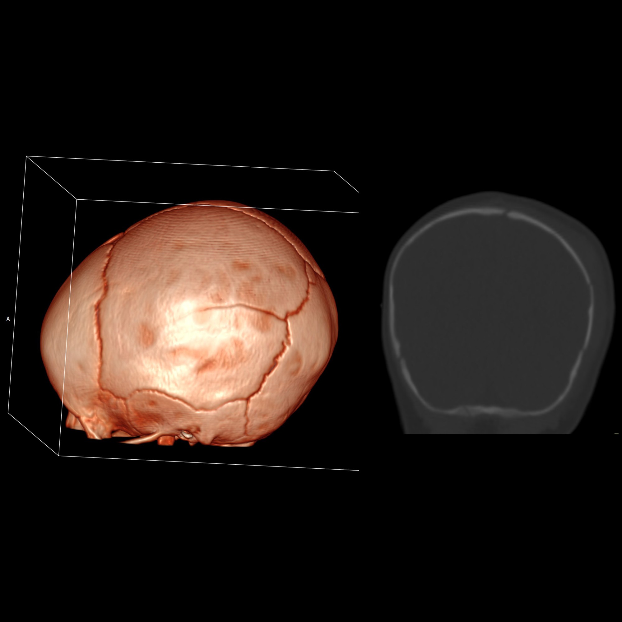 Pediatric Skull Fracture | Pediatric Radiology Reference Article ...