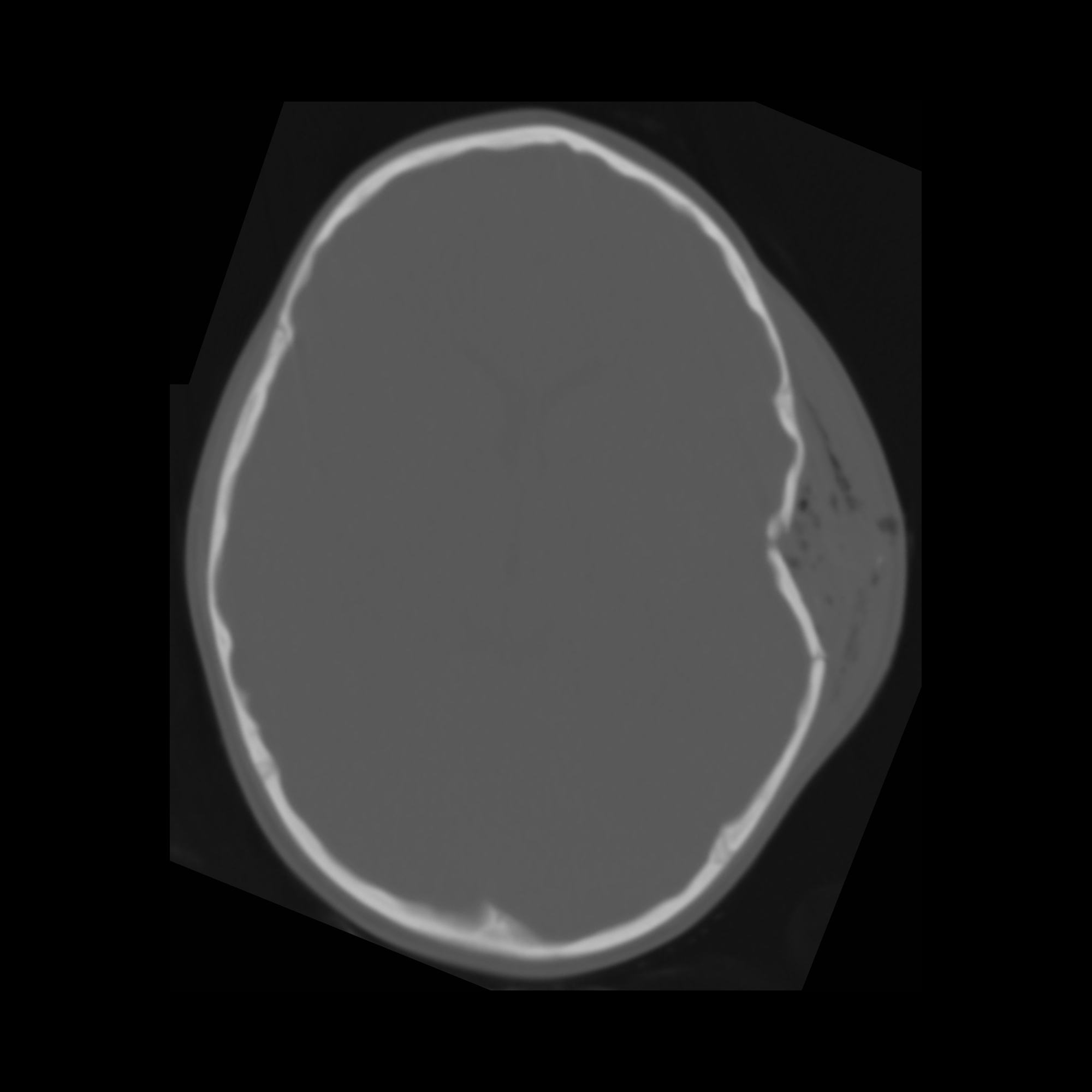 Pediatric Skull Fracture | Pediatric Radiology Reference Article ...