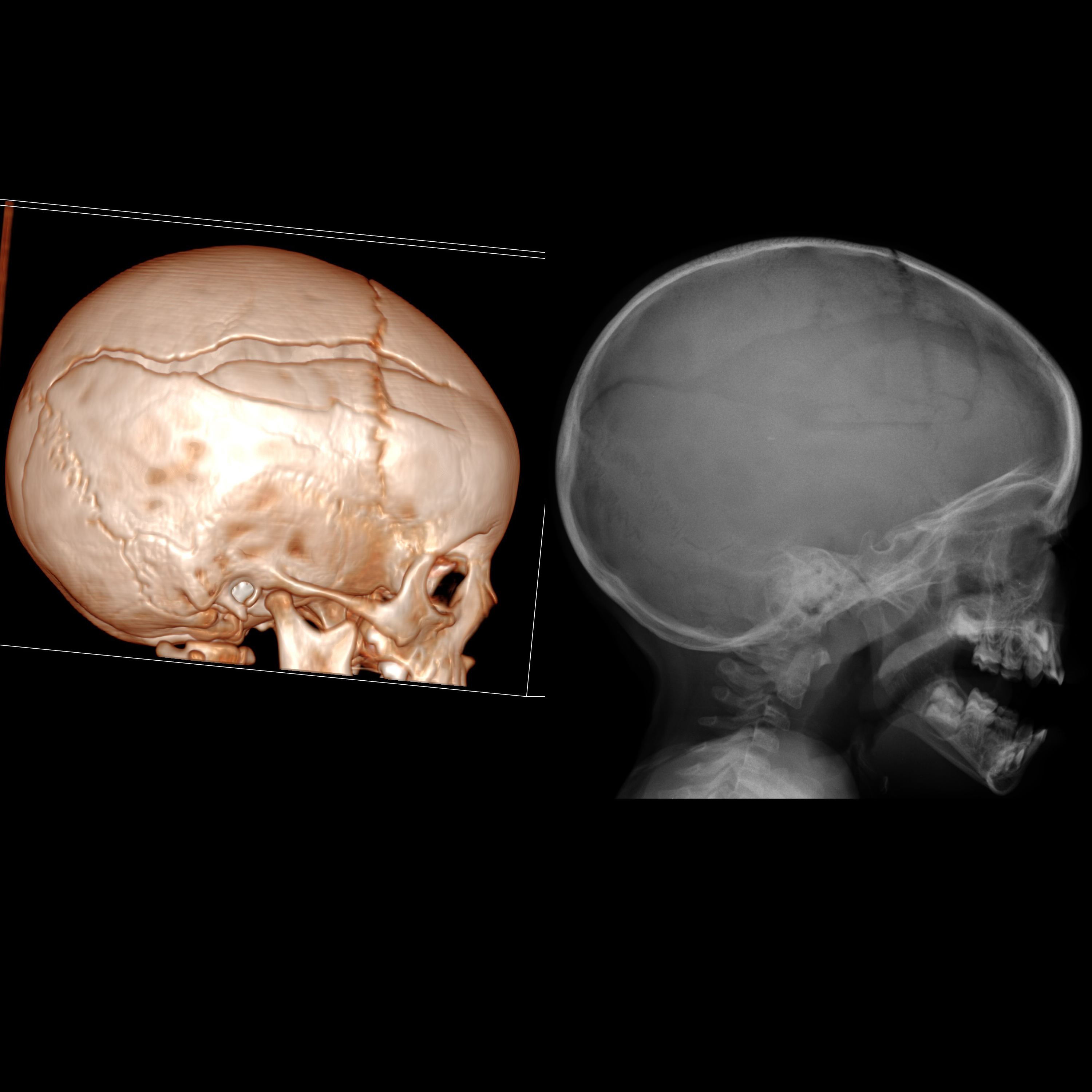 Pediatric Skull Fracture | Pediatric Radiology Reference Article ...