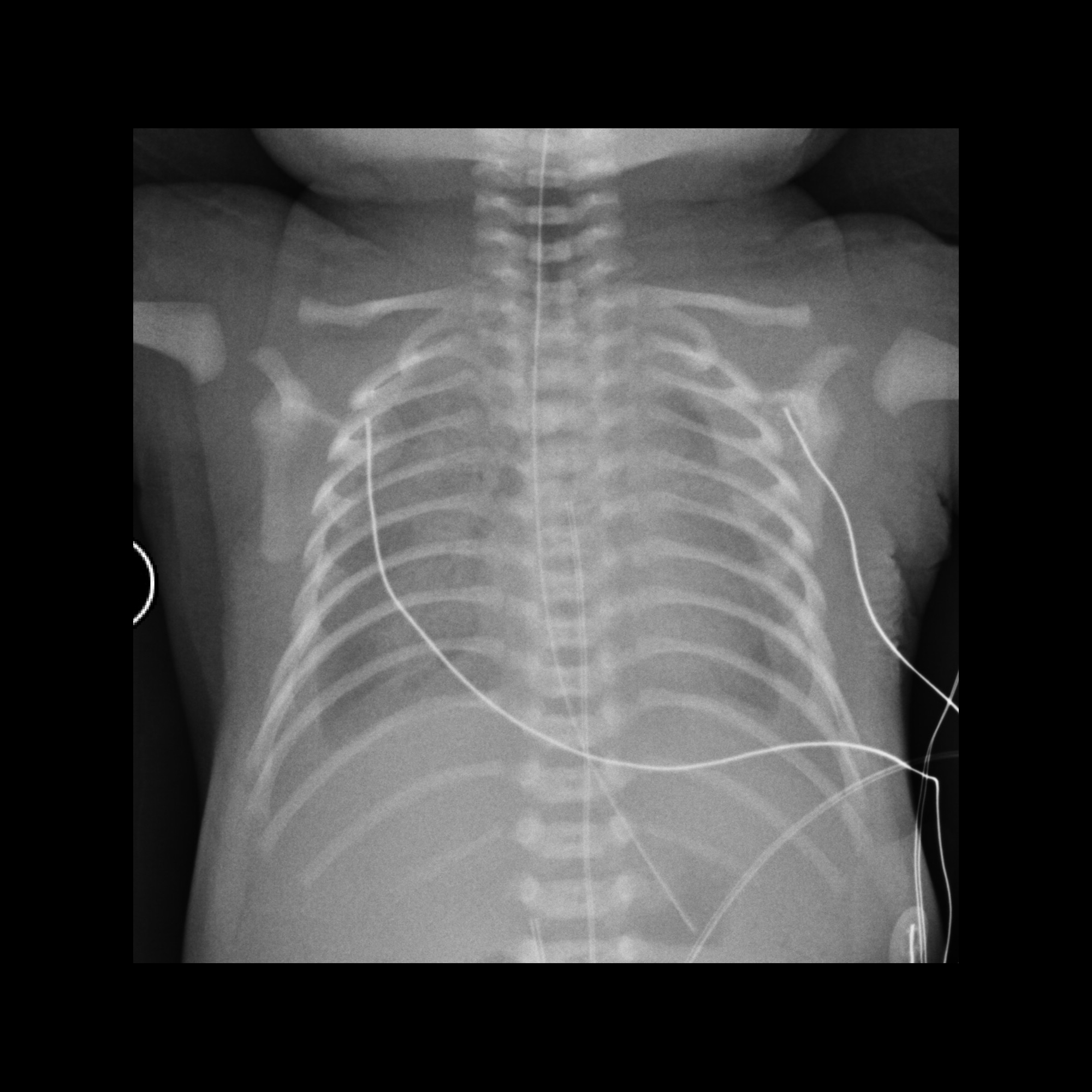 Hydrops Fetalis | Pediatric Radiology Reference Article | Pediatric ...
