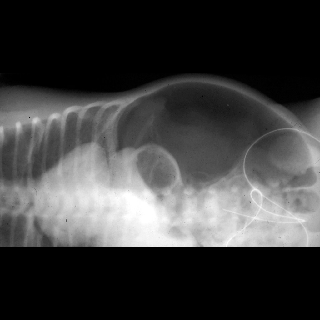 Pediatric Pneumoperitoneum | Pediatric Radiology Reference Article ...