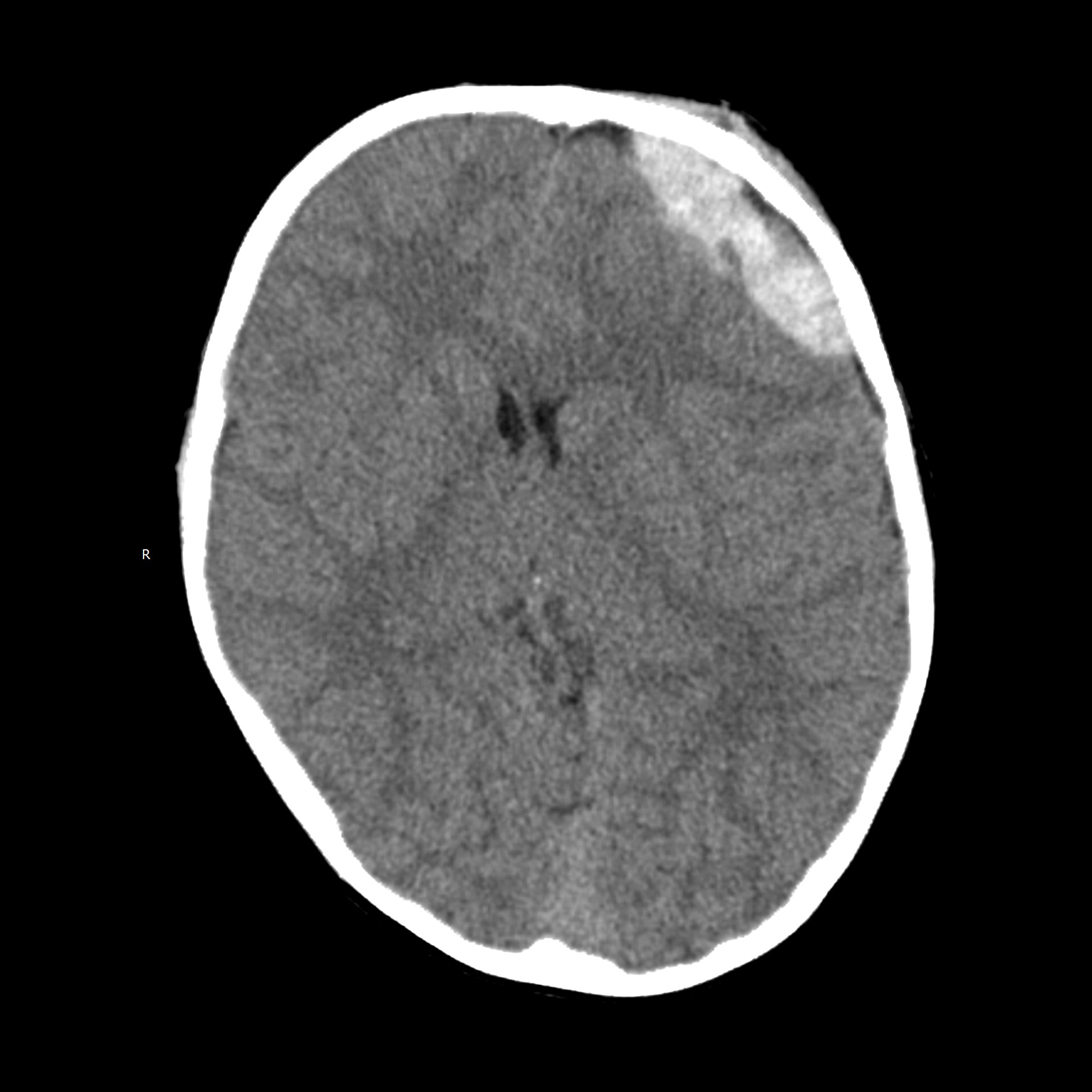 Pediatric Subgaleal Hematoma | Pediatric Radiology Reference Article ...