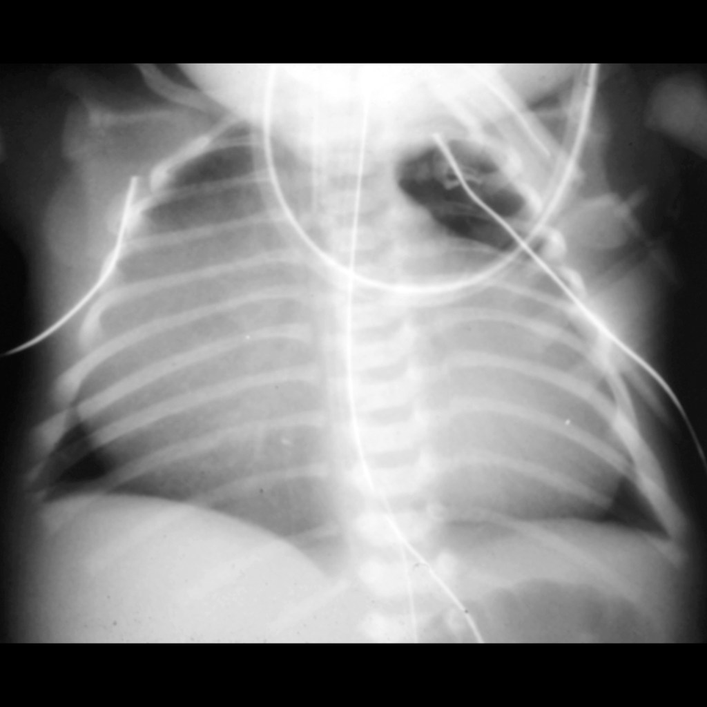 Ebstein Anomaly | Pediatric Radiology Reference Article | Pediatric ...