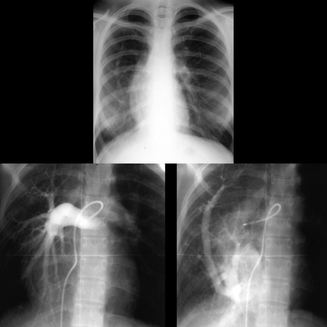 Partial Anomalous Pulmonary Venous Return | Pediatric Radiology ...