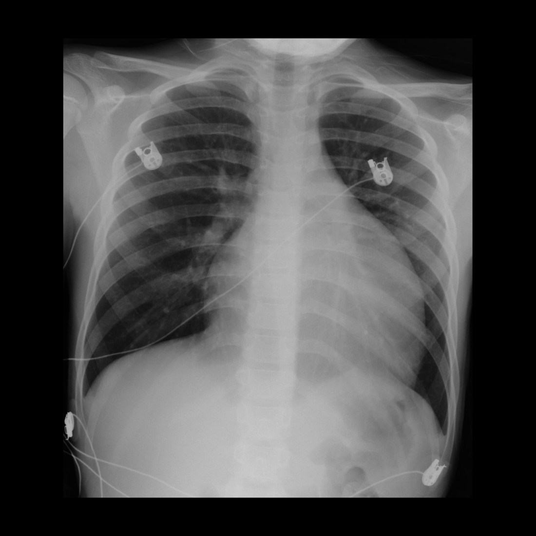 Pediatric Pericardial Effusion | Pediatric Radiology Reference Article ...