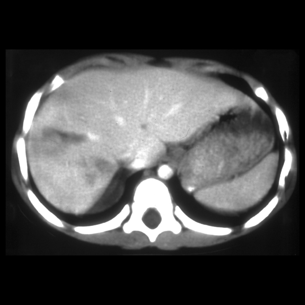 Pediatric Liver Trauma | Pediatric Radiology Reference Article ...