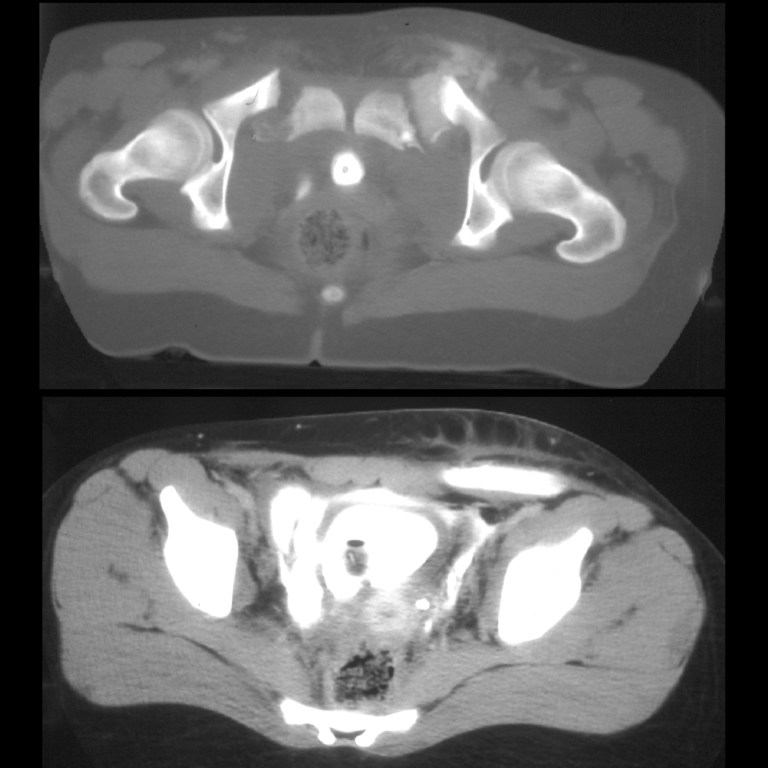 Pediatric Bladder Trauma | Pediatric Radiology Reference Article ...