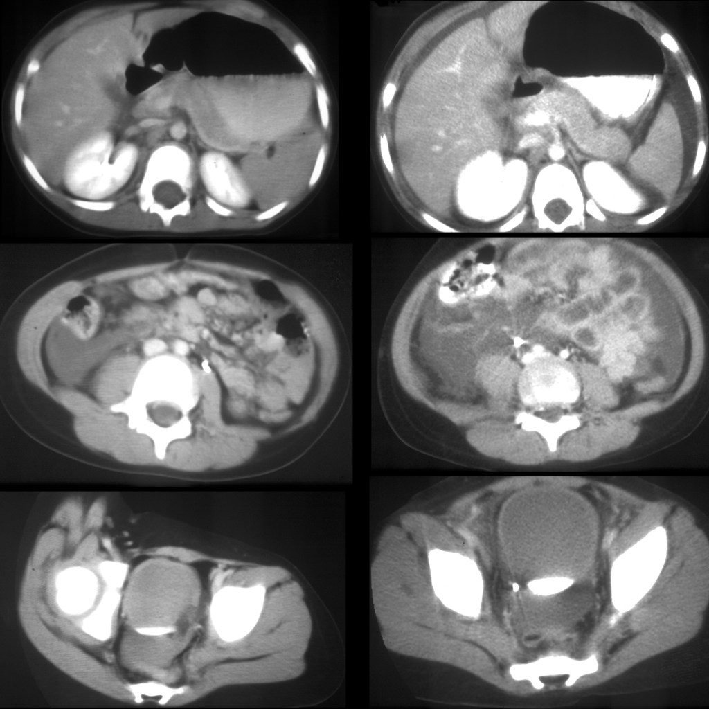 Pediatric Bowel Trauma | Pediatric Radiology Reference Article ...