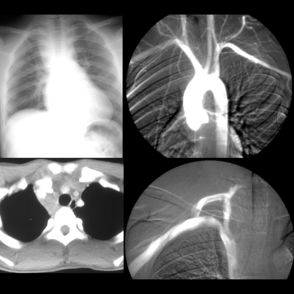 Sternoclavicular Joint Dislocation Management Of Sternoclavicular