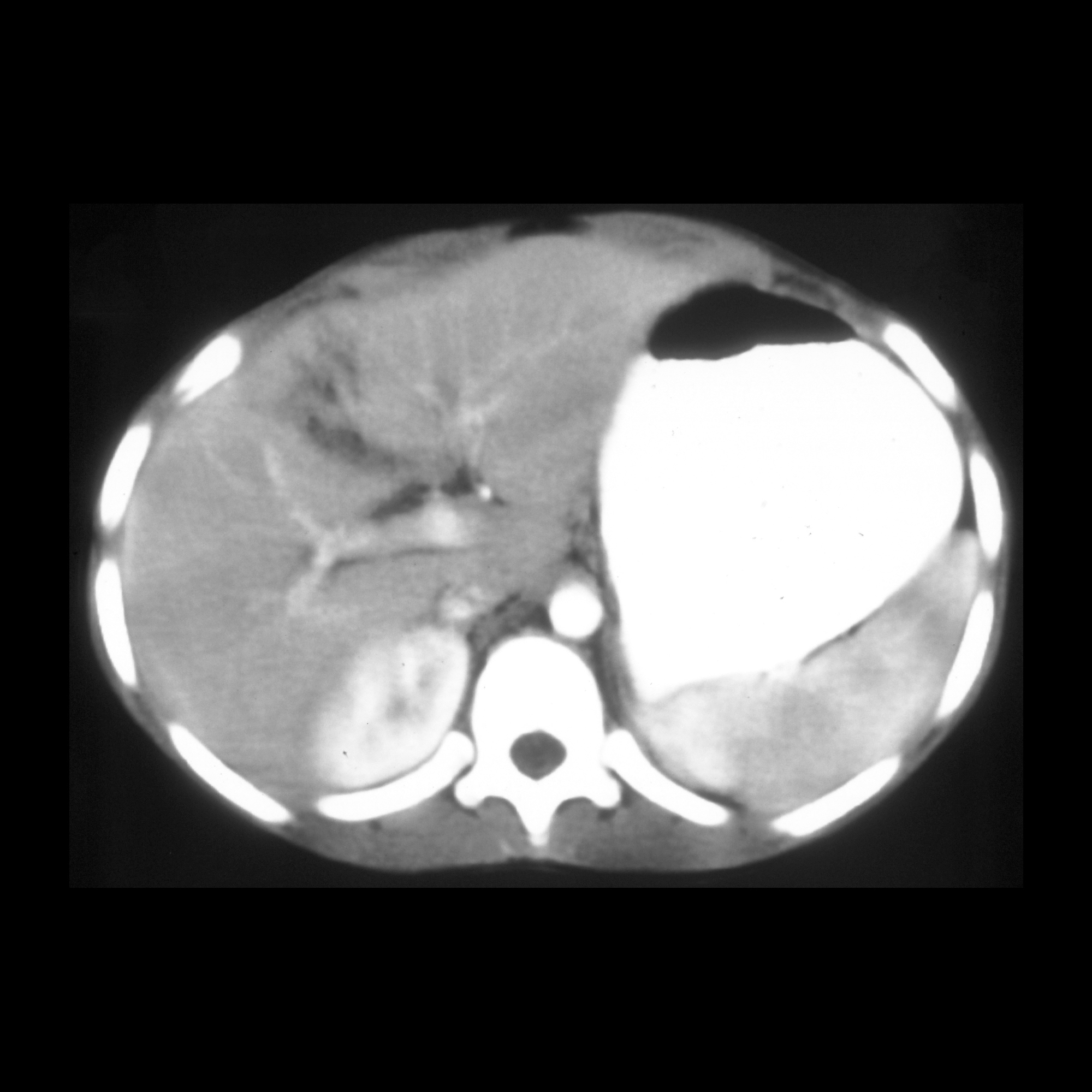 Pediatric Liver Trauma | Pediatric Radiology Reference Article ...