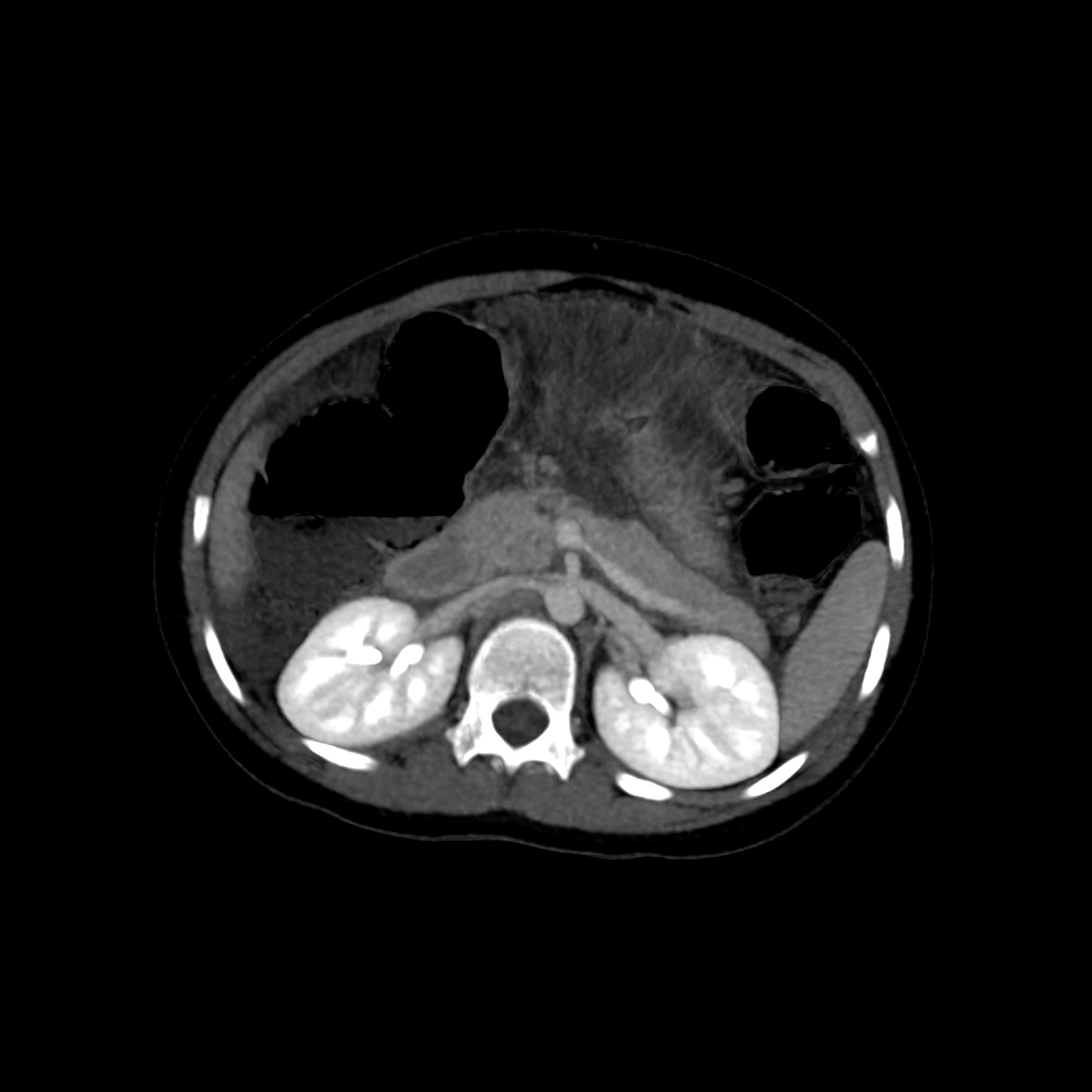 Pediatric Pancreatic Trauma | Pediatric Radiology Reference Article ...