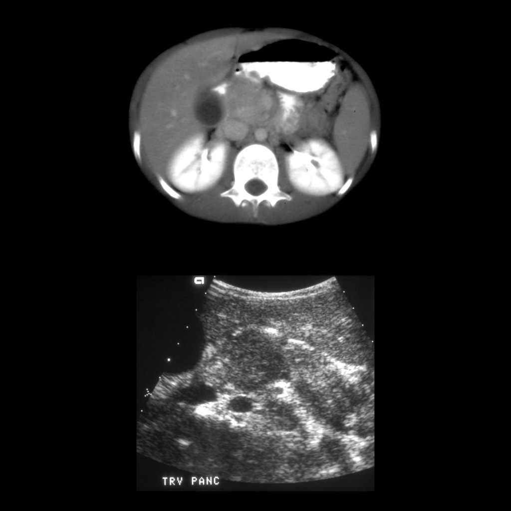 Pediatric Pancreatic Trauma | Pediatric Radiology Reference Article ...