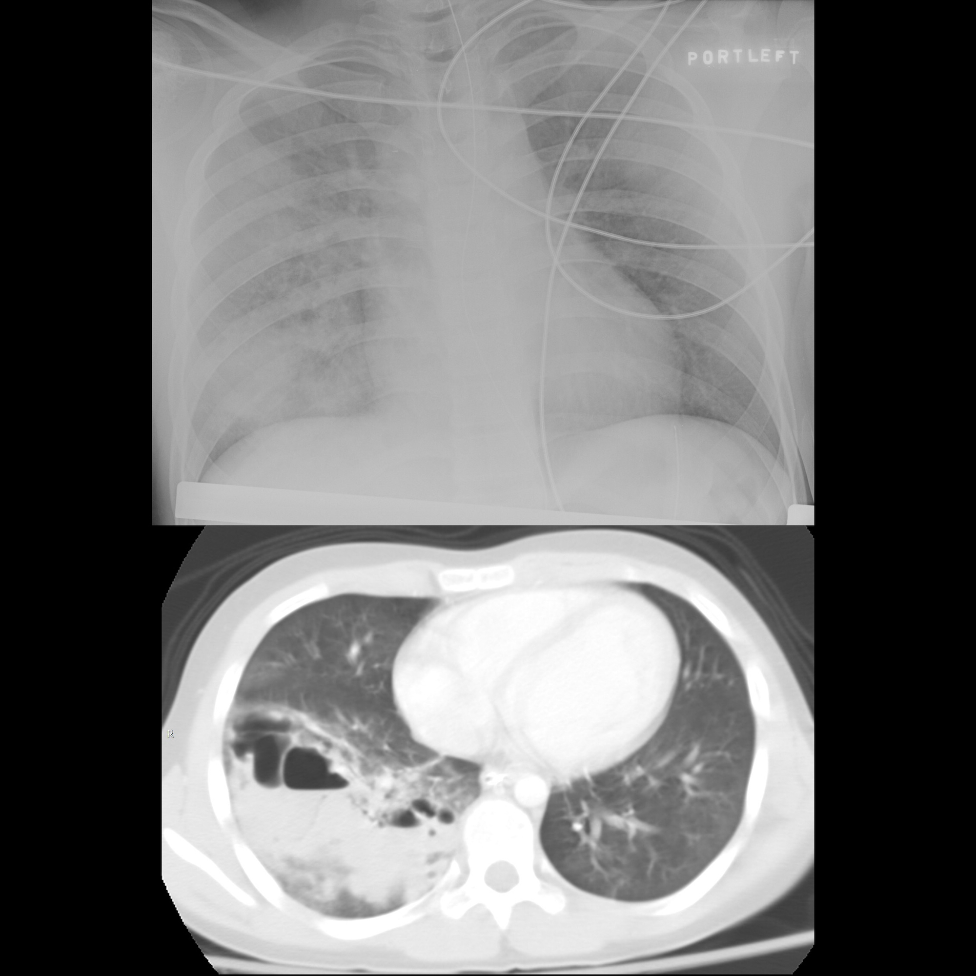 Pediatric Pneumatocele | Pediatric Radiology Reference Article ...