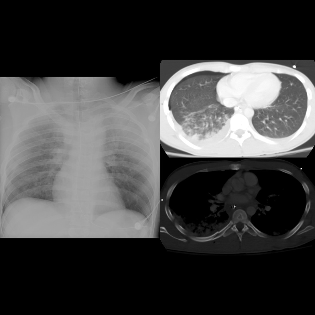 Pediatric Rib Fracture | Pediatric Radiology Reference Article ...