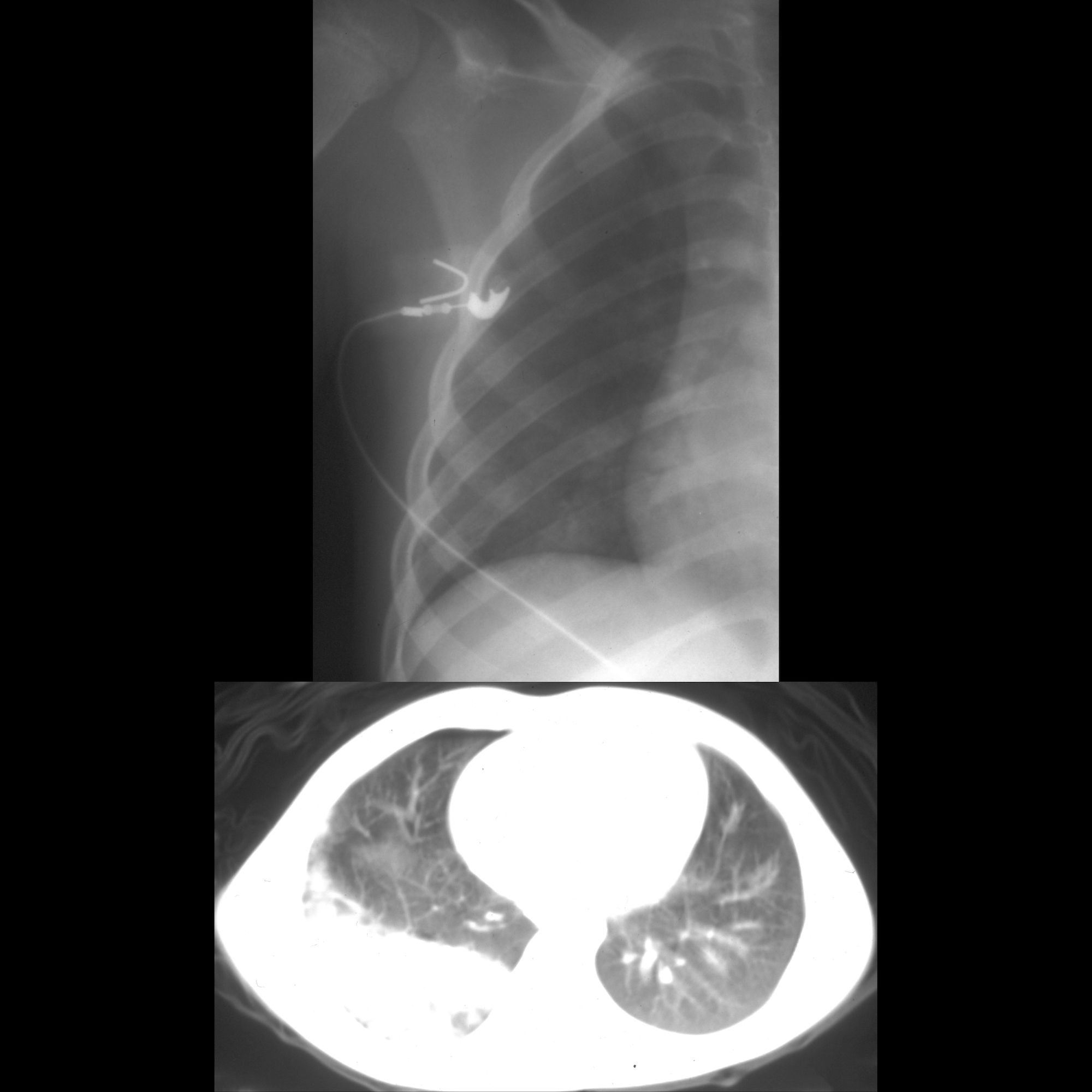Pediatric Rib Fracture | Pediatric Radiology Reference Article ...