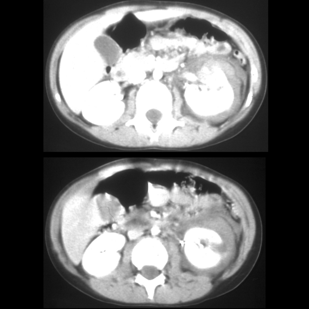 Pediatric Renal Trauma | Pediatric Radiology Reference Article ...
