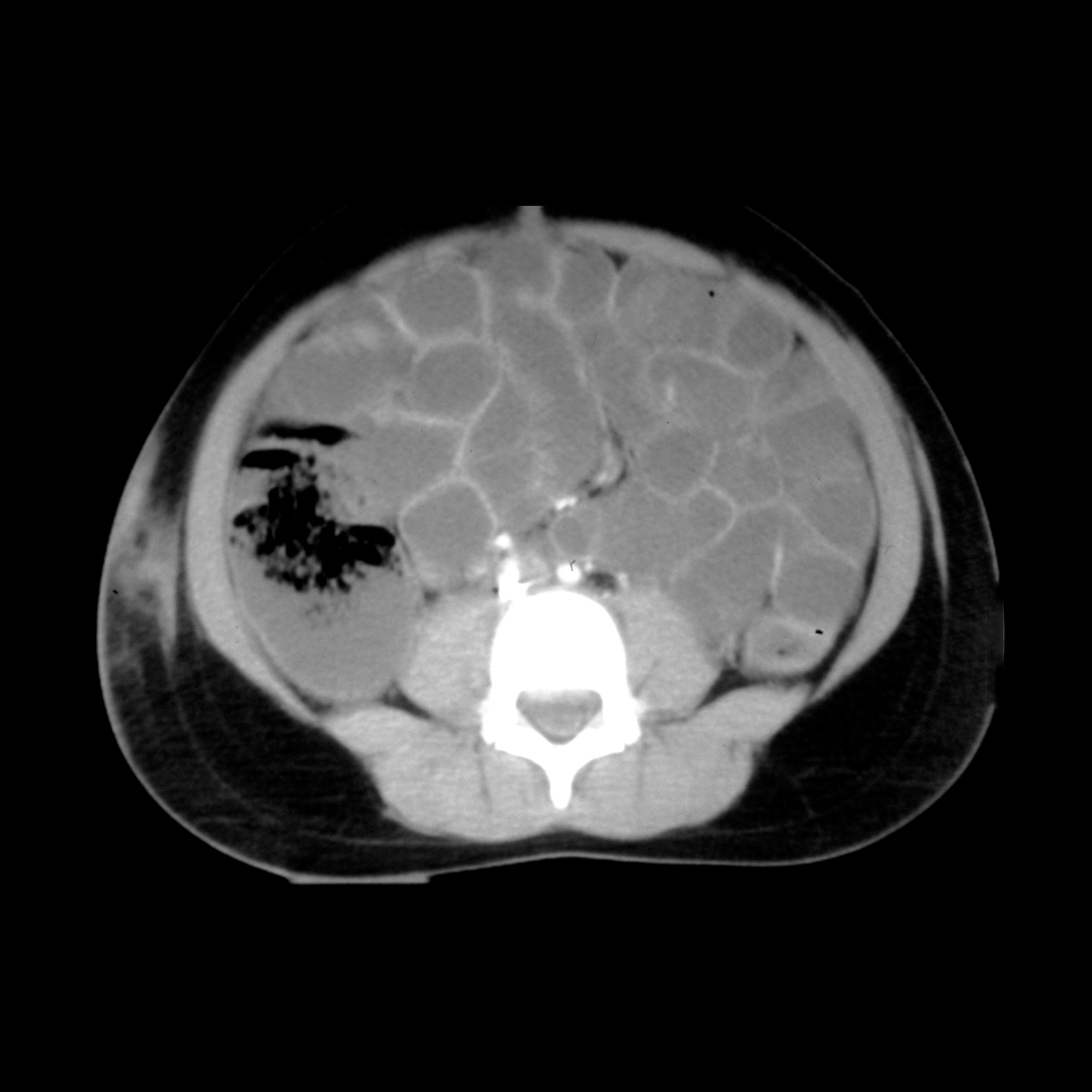 Hypoperfusion Complex | Pediatric Radiology Reference Article ...