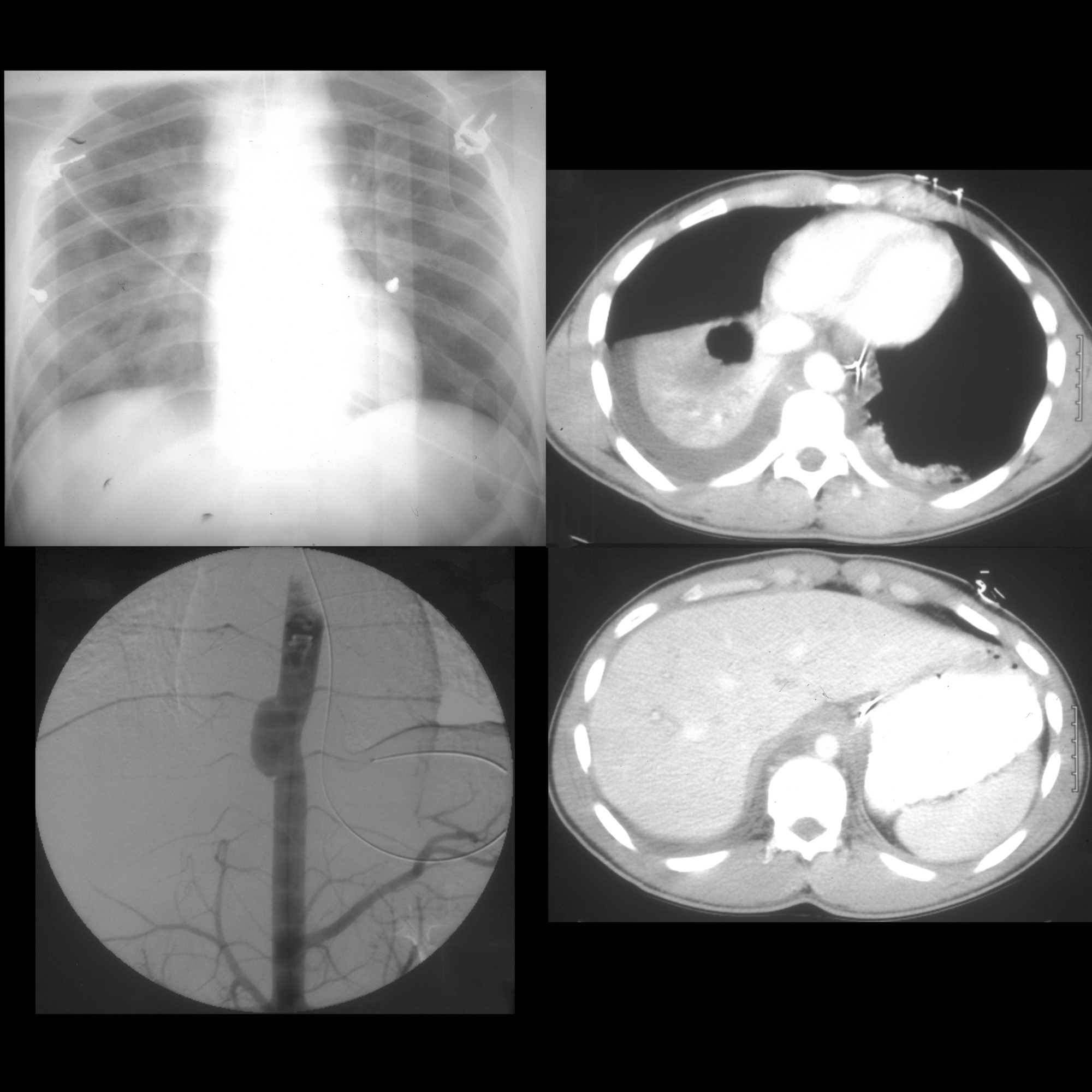 Pediatric Thoracic Aortic Injury | Pediatric Radiology Reference ...