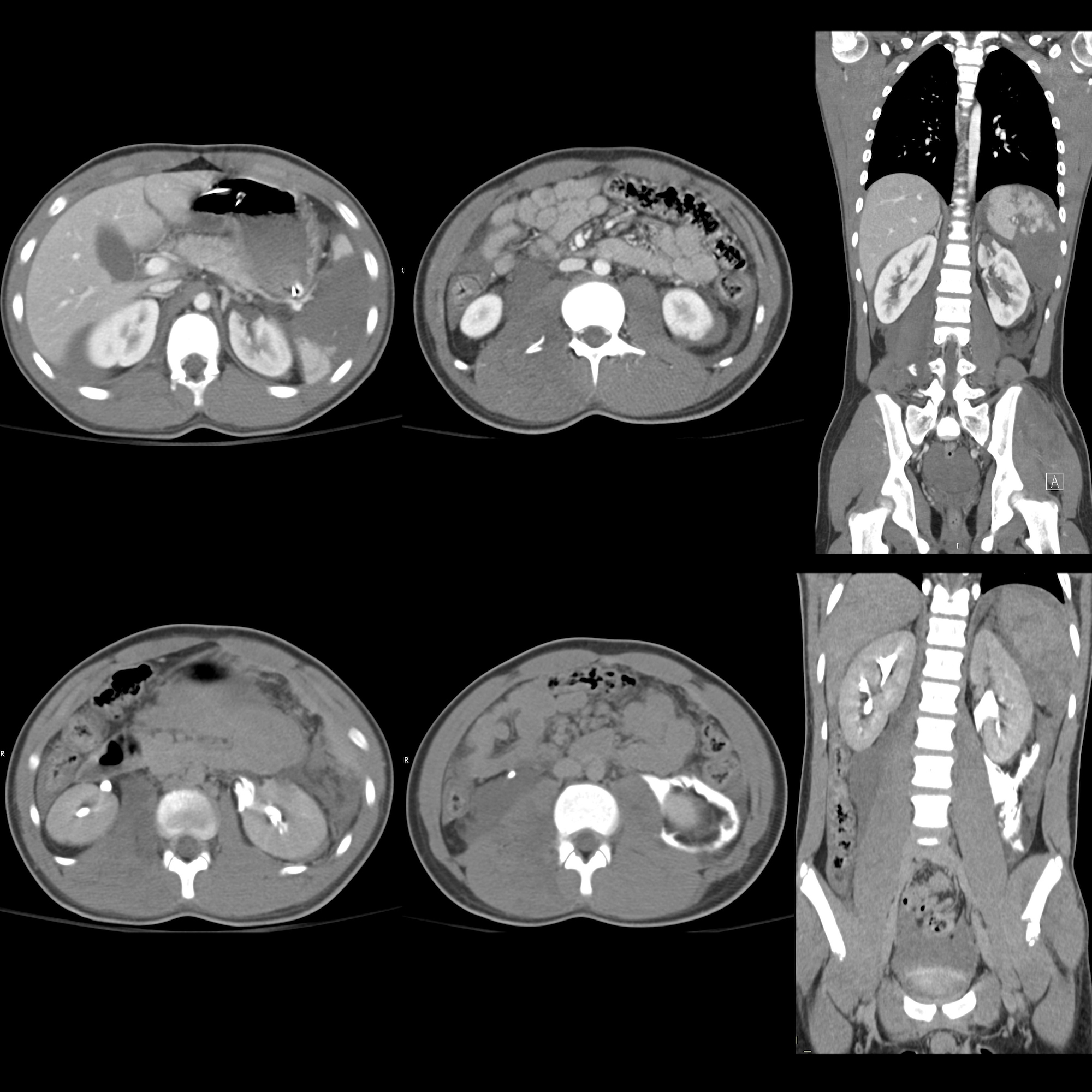 Pediatric Splenic Trauma | Pediatric Radiology Reference Article ...