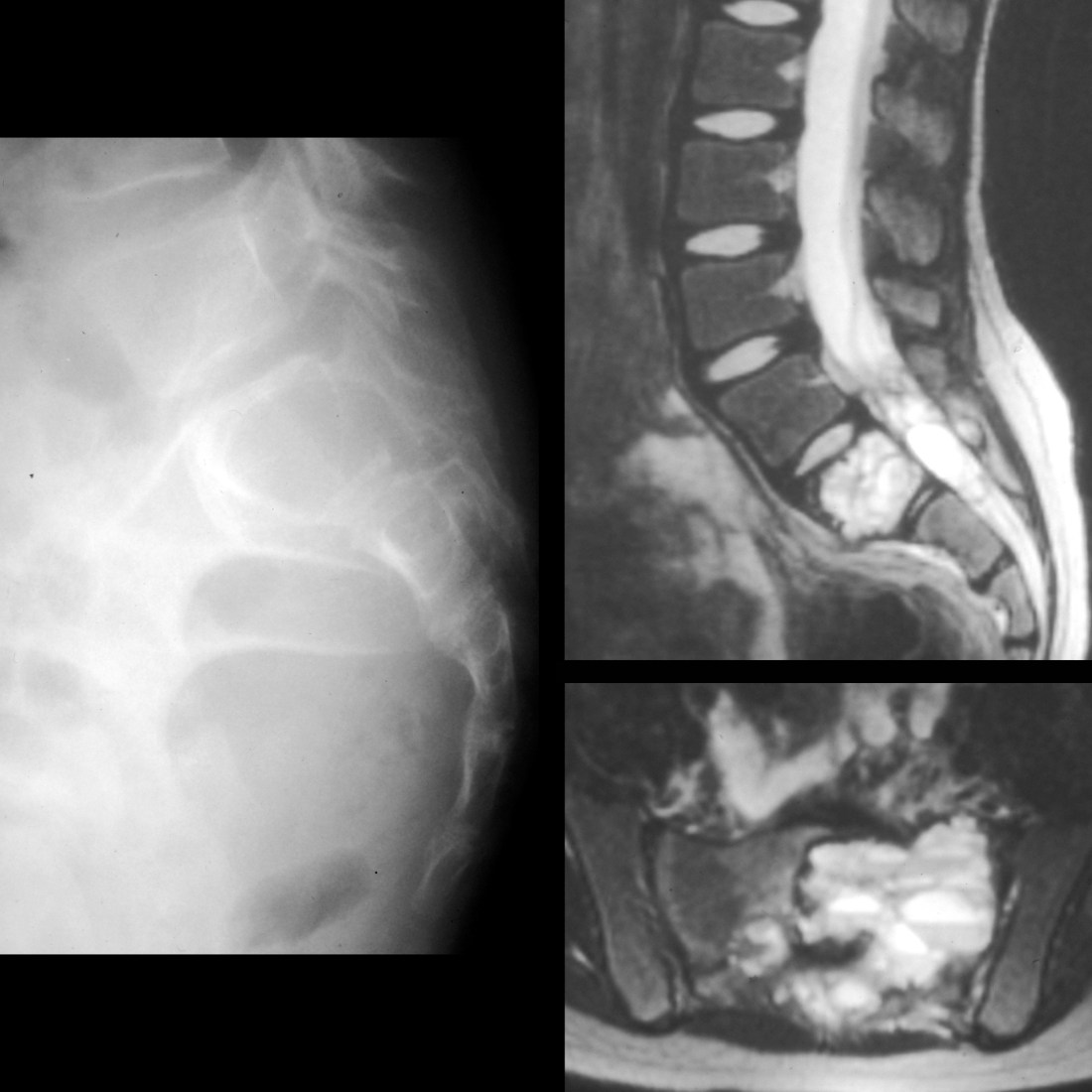Pediatric Aneurysmal Bone Cyst | Pediatric Radiology Reference Article ...