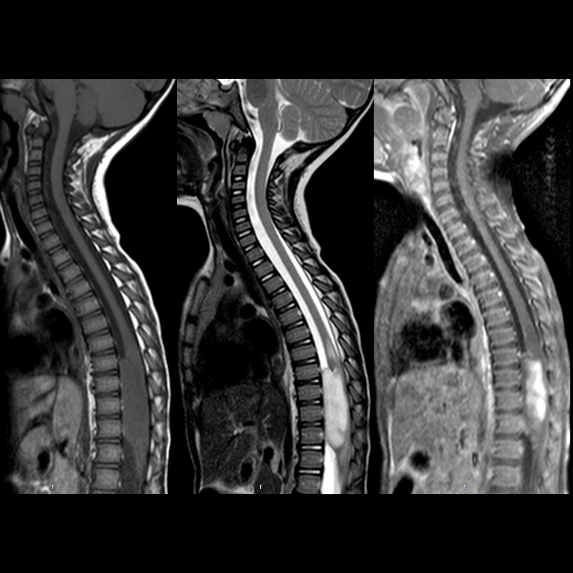 Pediatric Astrocytoma Spinal Cord | Pediatric Radiology Reference ...