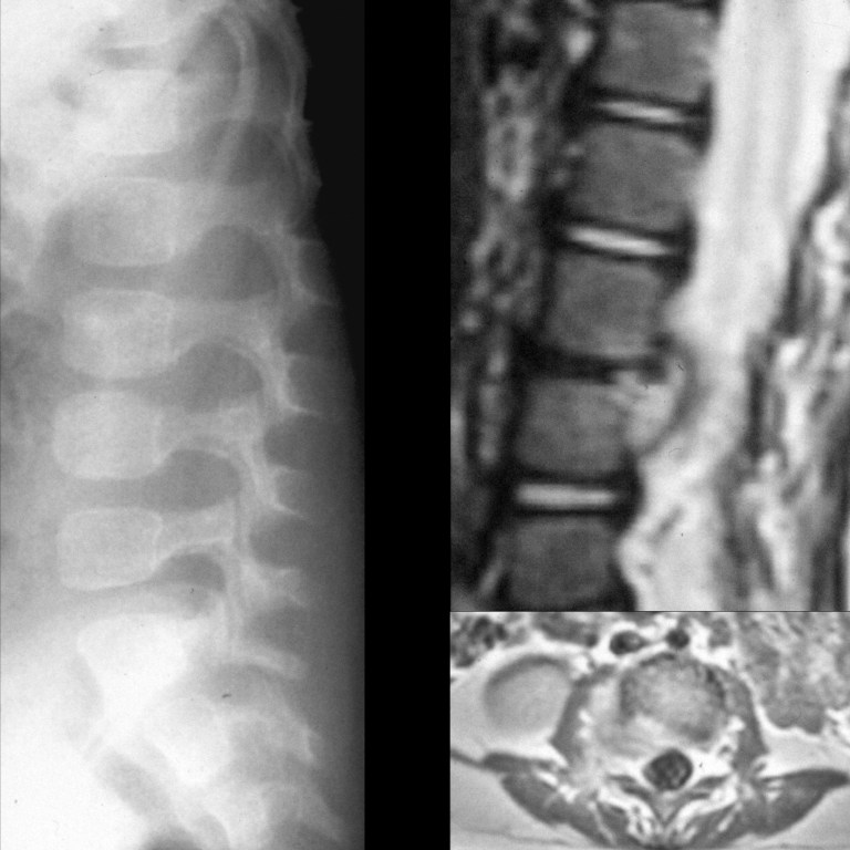 Pediatric Osteomyelitis Discitis | Pediatric Radiology Reference ...