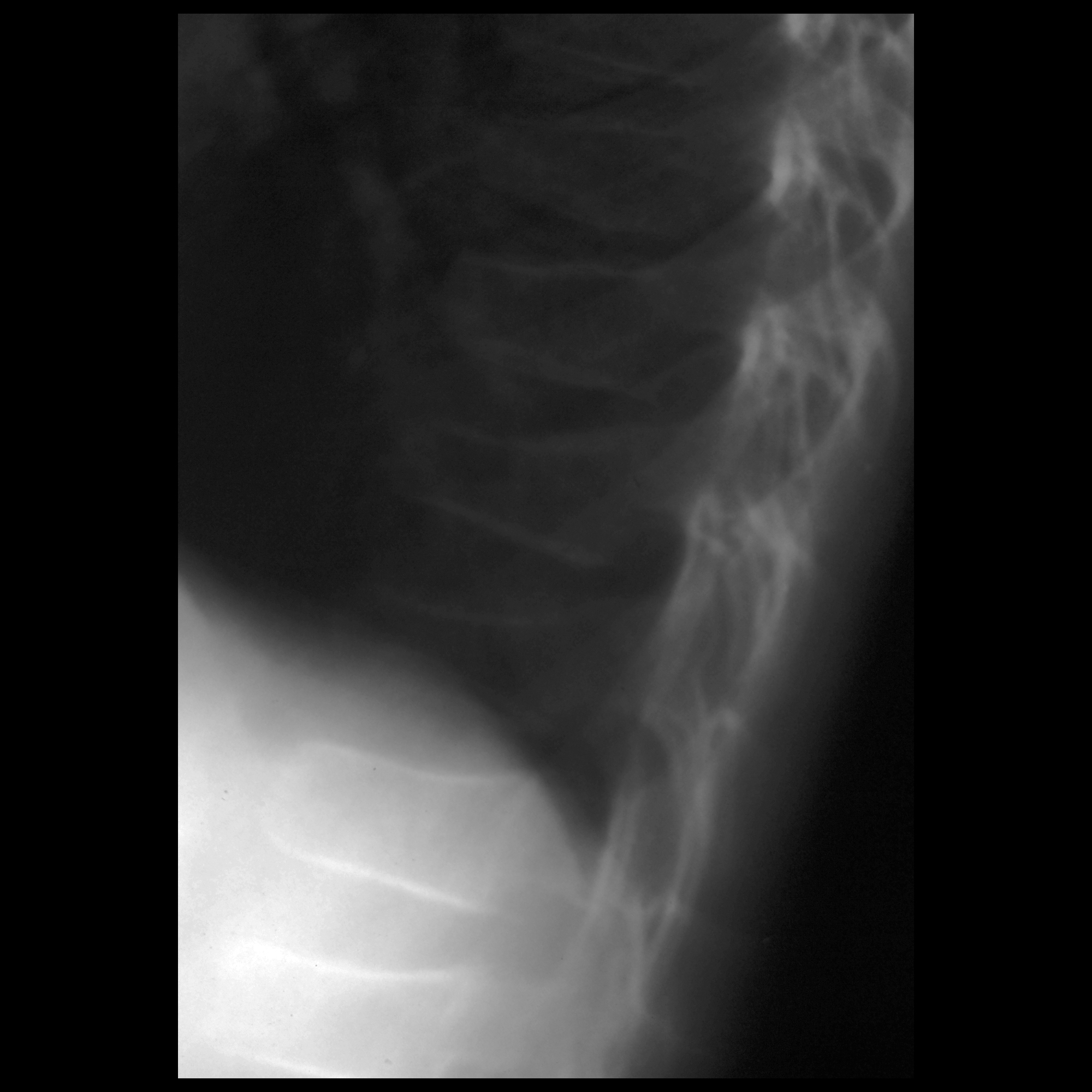 Toddler with back pain | Pediatric Radiology Case | Pediatric Imaging ...