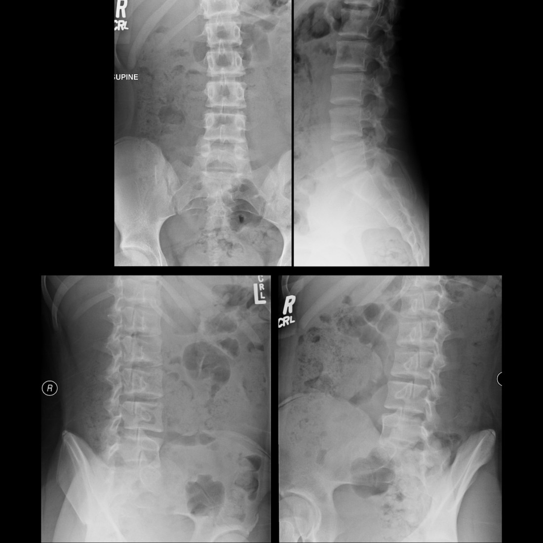 Pediatric Mechanical Back Pain | Pediatric Radiology Reference Article ...