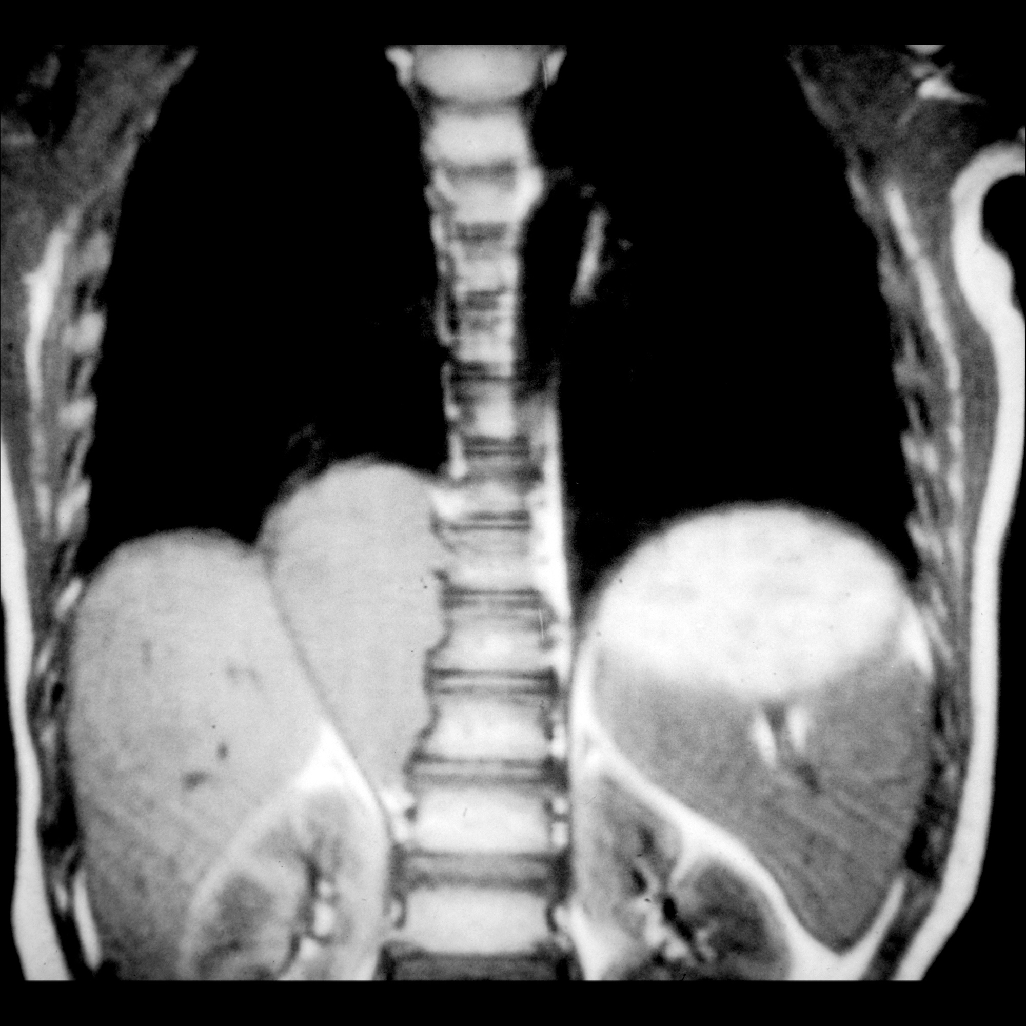 Toddler with back pain | Pediatric Radiology Case | Pediatric Imaging ...