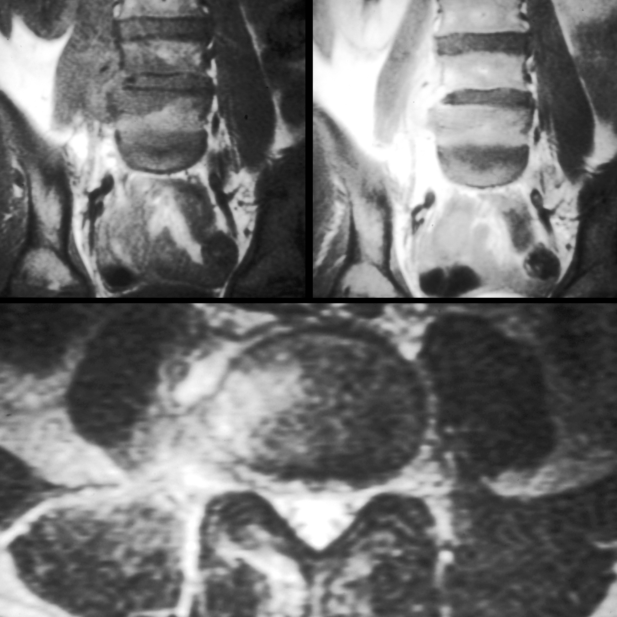 Pediatric Osteomyelitis Discitis | Pediatric Radiology Reference ...