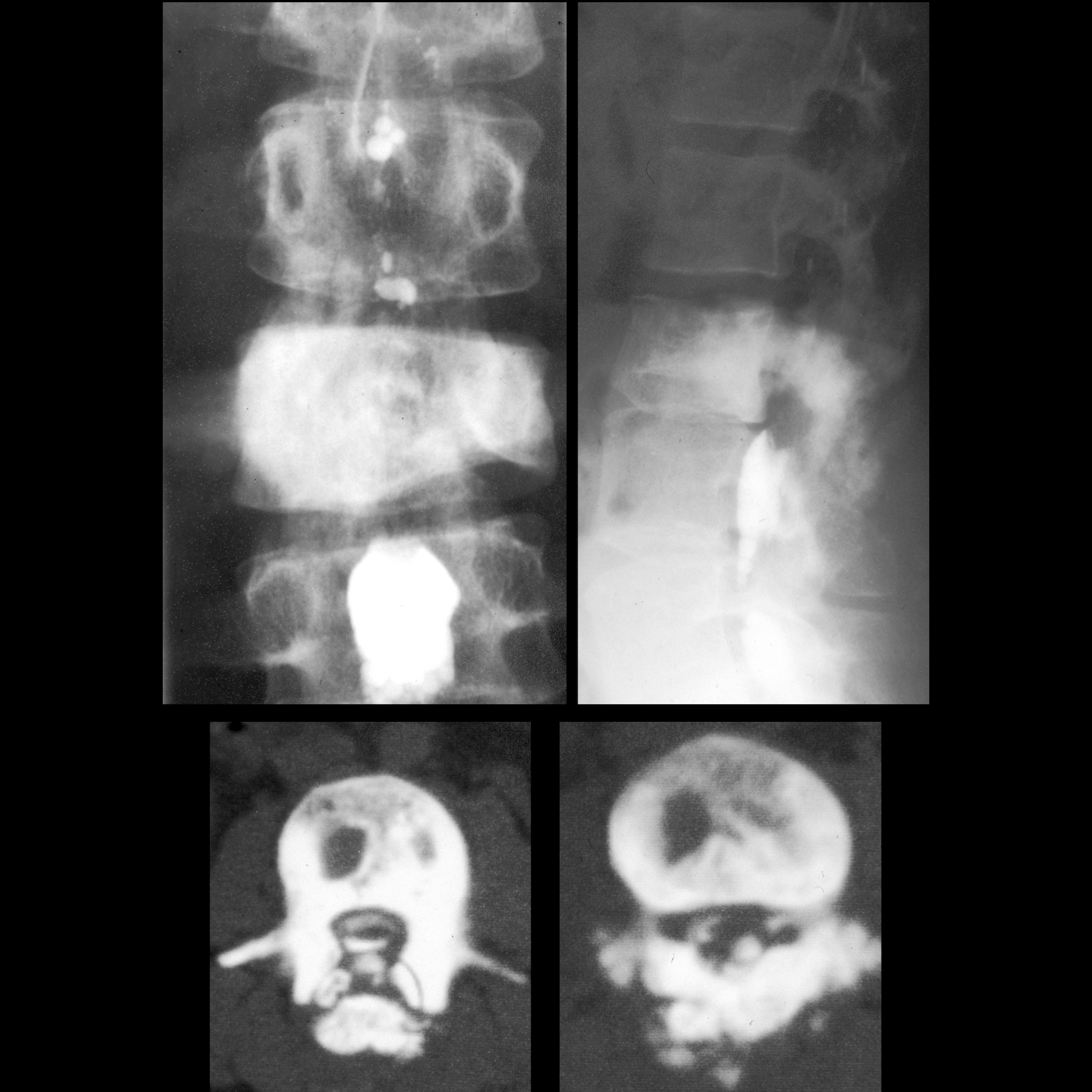 Teenager with back pain | Pediatric Radiology Case | Pediatric Imaging ...