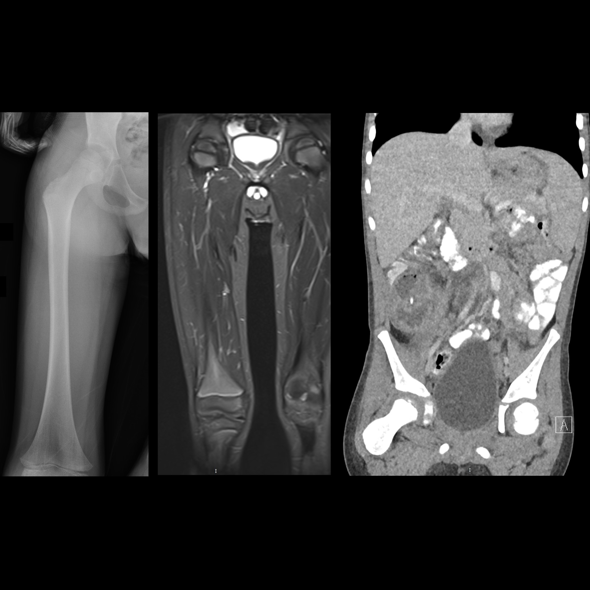 Pediatric Appendicitis | Pediatric Radiology Reference Article ...