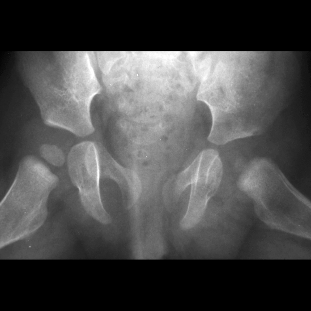 Developmental Dysplasia of the Hip | Pediatric Radiology Reference ...