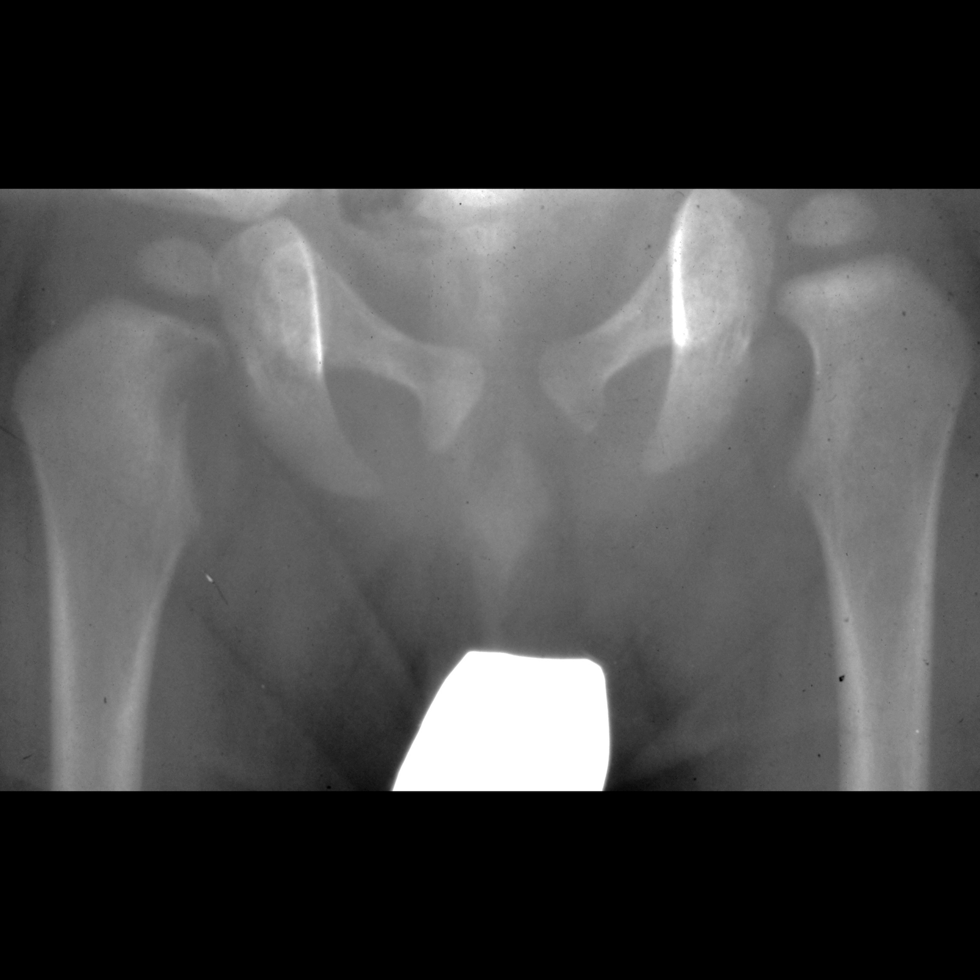 Infant with right hip pain | Pediatric Radiology Case | Pediatric ...