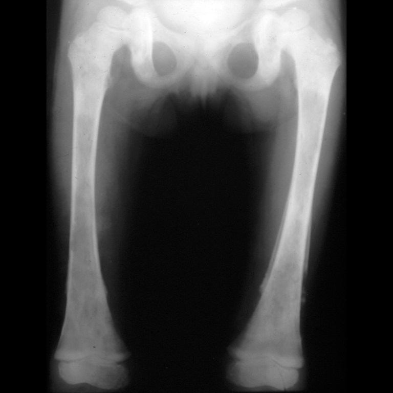 Preschooler with bilateral hip pain | Pediatric Radiology Case ...