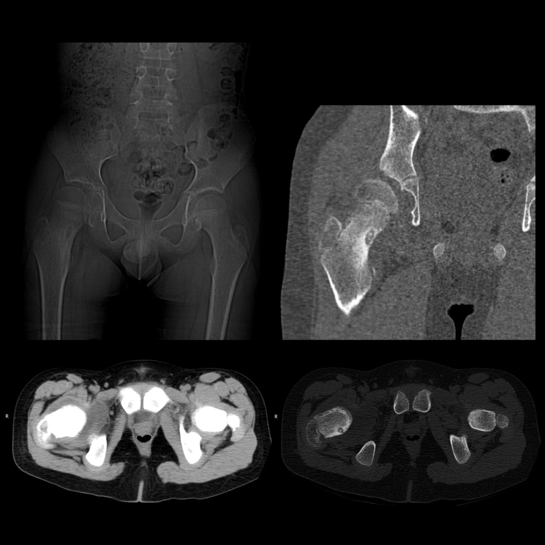 School ager with right hip pain | Pediatric Radiology Case | Pediatric ...