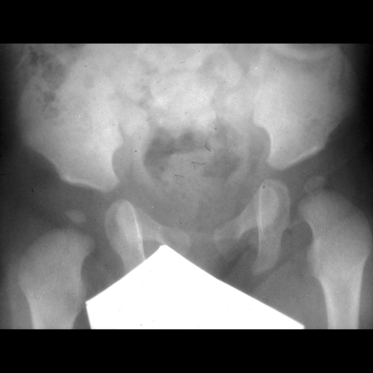 Pediatric Septic Arthritis of Hip | Pediatric Radiology Reference ...