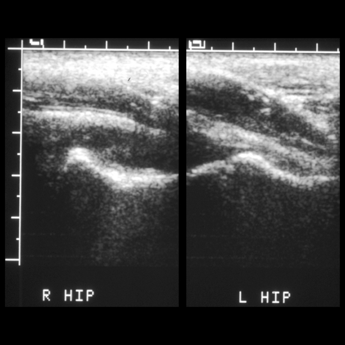 Pediatric Transient Synovitis of Hip | Pediatric Radiology Reference ...