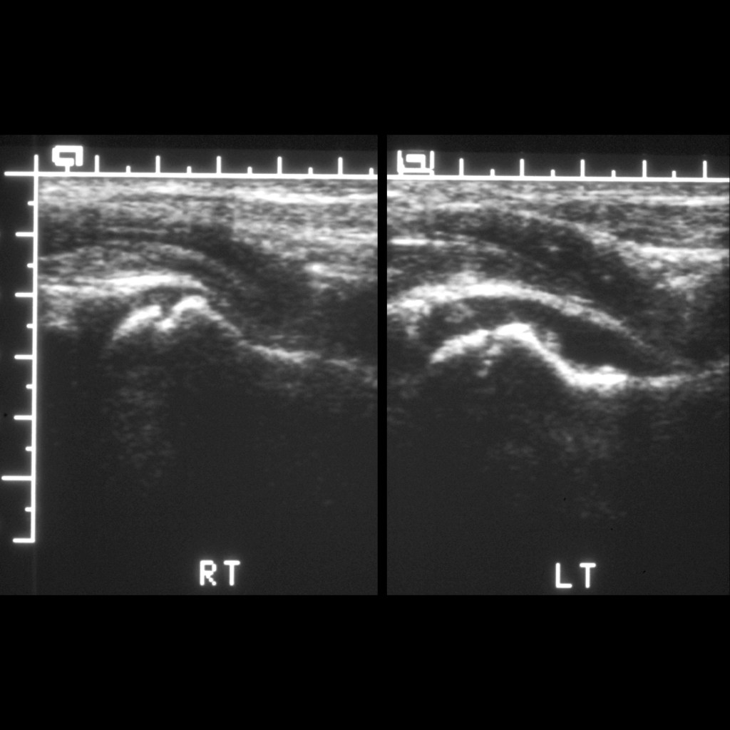 Pediatric Transient Synovitis of Hip | Pediatric Radiology Reference ...