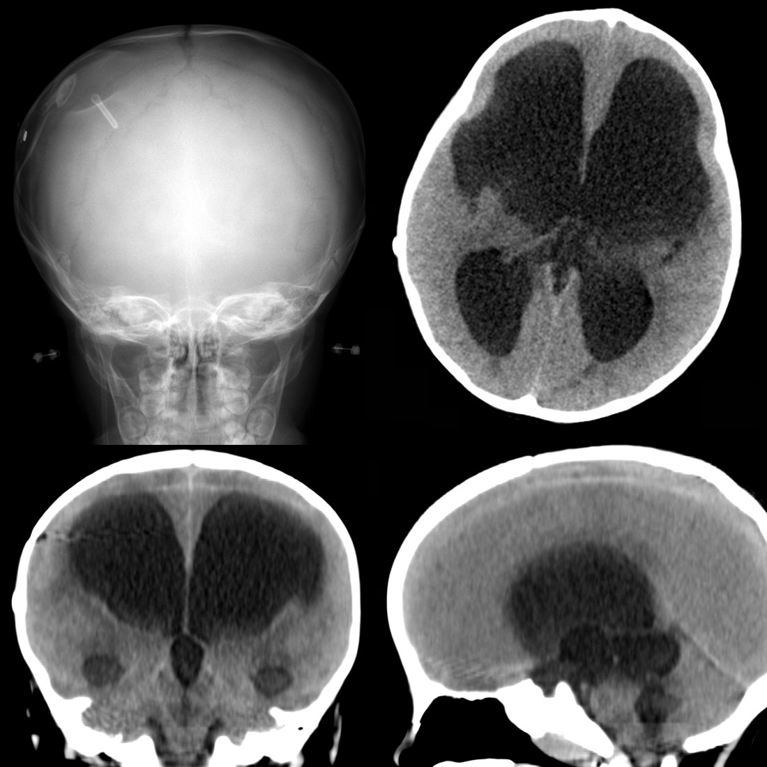 Pediatric Ventriculoperitoneal Shunt Malfunction / Malposition ...